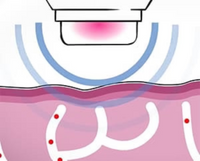 SECRETREZA™ RF Wand